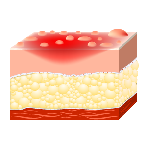 Treating Different Types of Burns